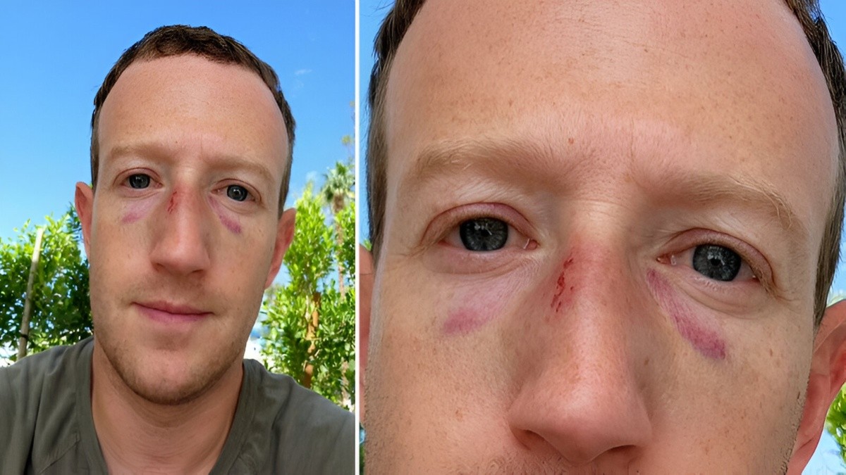 Mark Zuckerberg Uploads Selfie With Bruises On His Face. Here's What ...